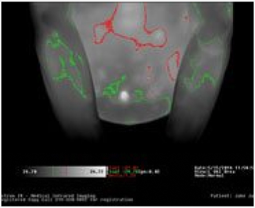 Software Dedicated for Medical Use- Spectron IR Medical Infrared Imaging